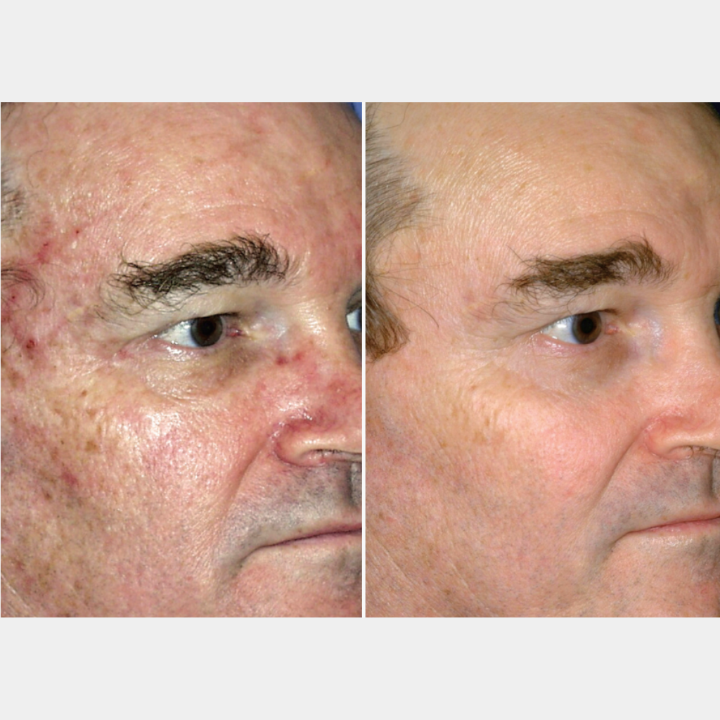 Micro Laser Peel – Skintervention Spa